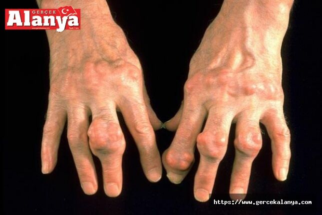 Gut hastalığı nedir? Gut hastalığına ne iyi gelir? - Gerçek Alanya Gazetesi